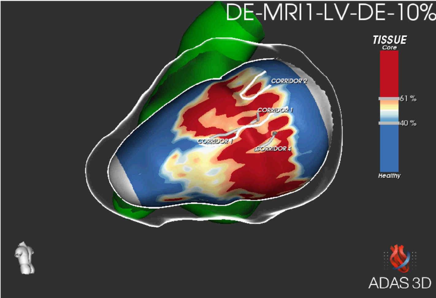 Case of VT procedure using ADAS3D with Ensite and HD-grid - Adas 3D