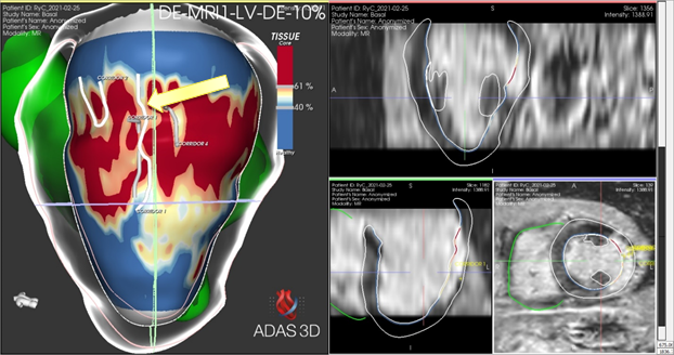 Case of VT procedure using ADAS3D with Ensite and HD-grid - Adas 3D