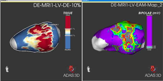 Case of VT procedure using ADAS3D with Ensite and HD-grid - Adas 3D